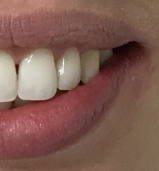Dr. Lior Burg | Invisalign