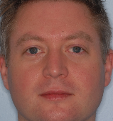 Oliver Bowyer | Invisalign